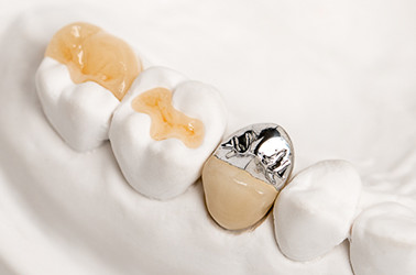 inlays-onlays-teilkronen - Flemming International